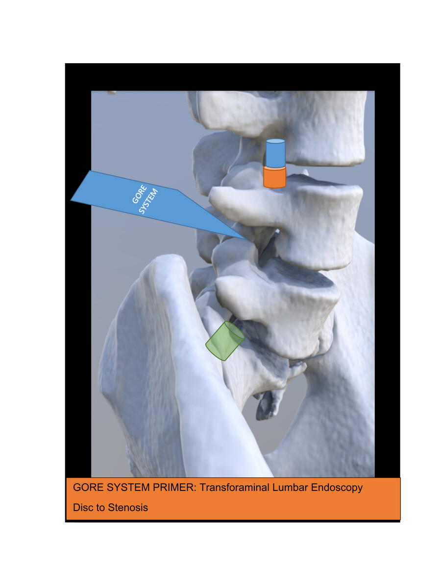 DR GORE GORE SYSTEM PRIMER : endoscopy from disc to stenosis by Dr ...