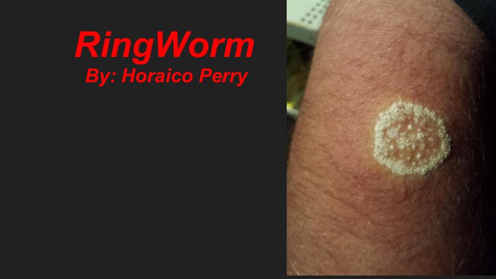 Ringworm by Horaico Perry - Flipsnack