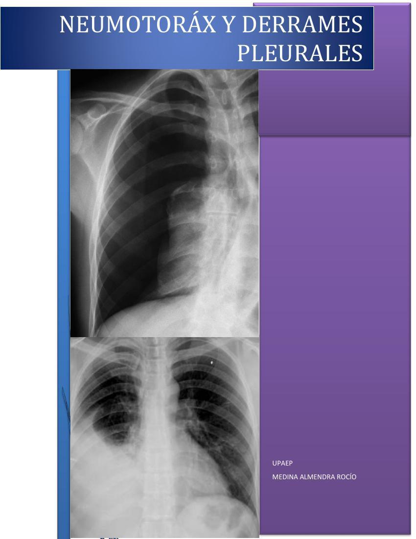 NEUMOTORAX (1) DERRAME PLEURAL by Rocio - Flipsnack